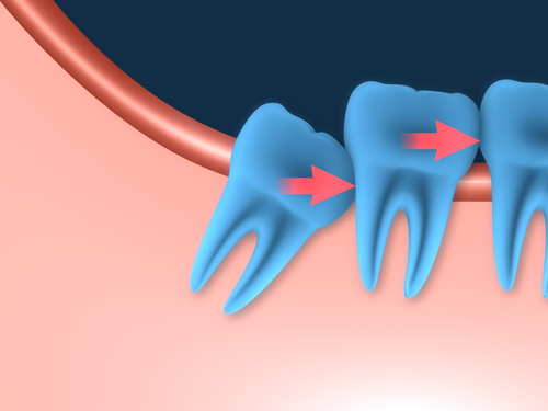 Bite Sized Wisdom: Facts on Wisdom Teeth